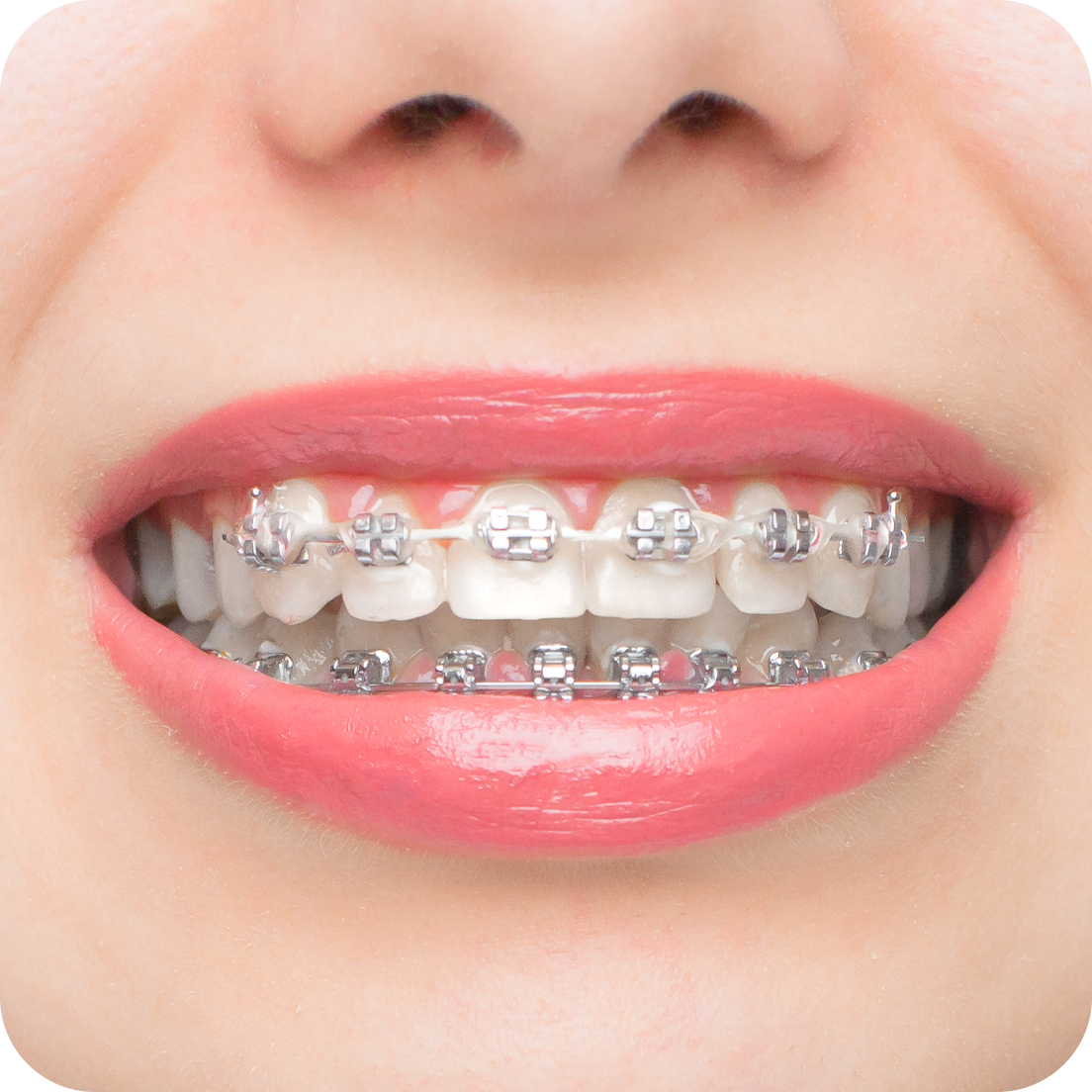Alineadores dentales vs otros métodos de alineación dental